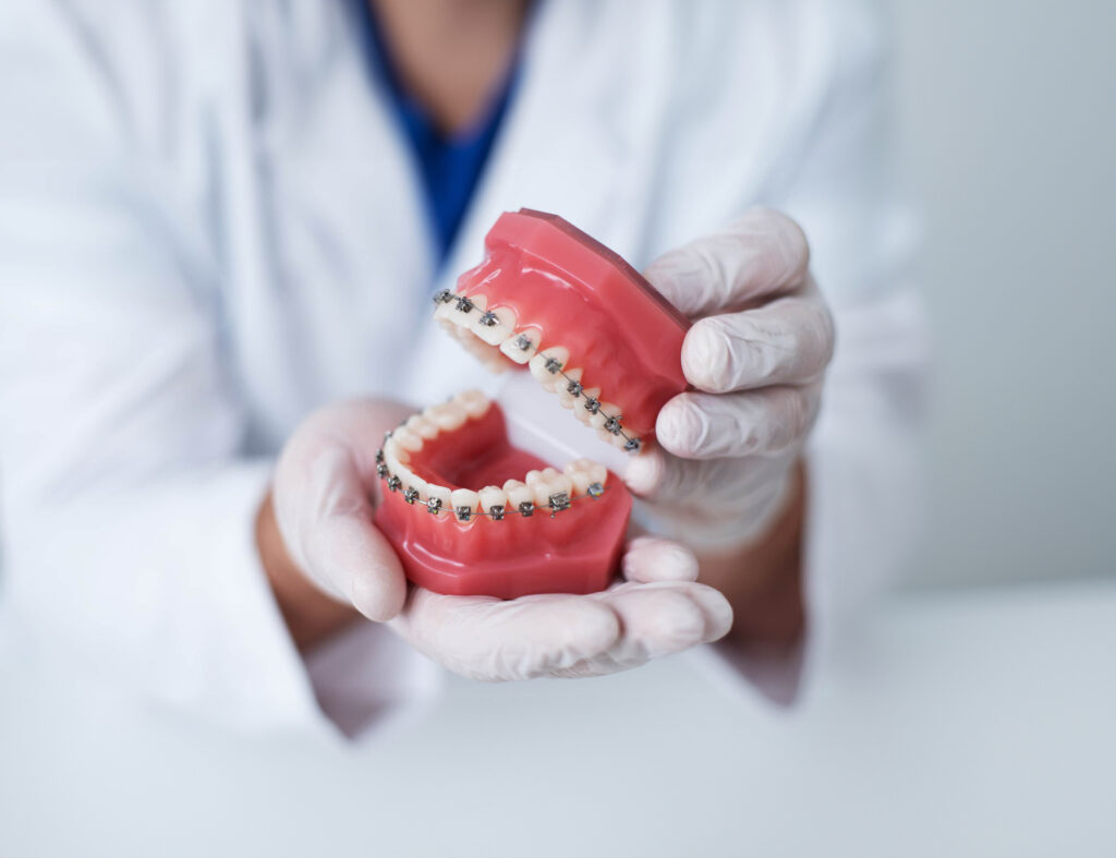 Get Braces in Norwich & Start Smiling